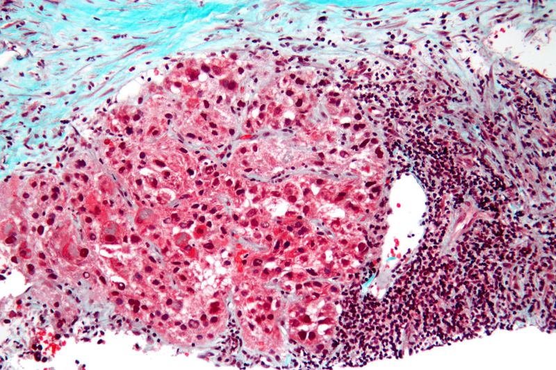Inside Precision Medicine on LinkedIn: Tertiary Lymphoid Structures ... Inside Precision Medicine on LinkedIn: Tertiary Lymphoid Structures ...