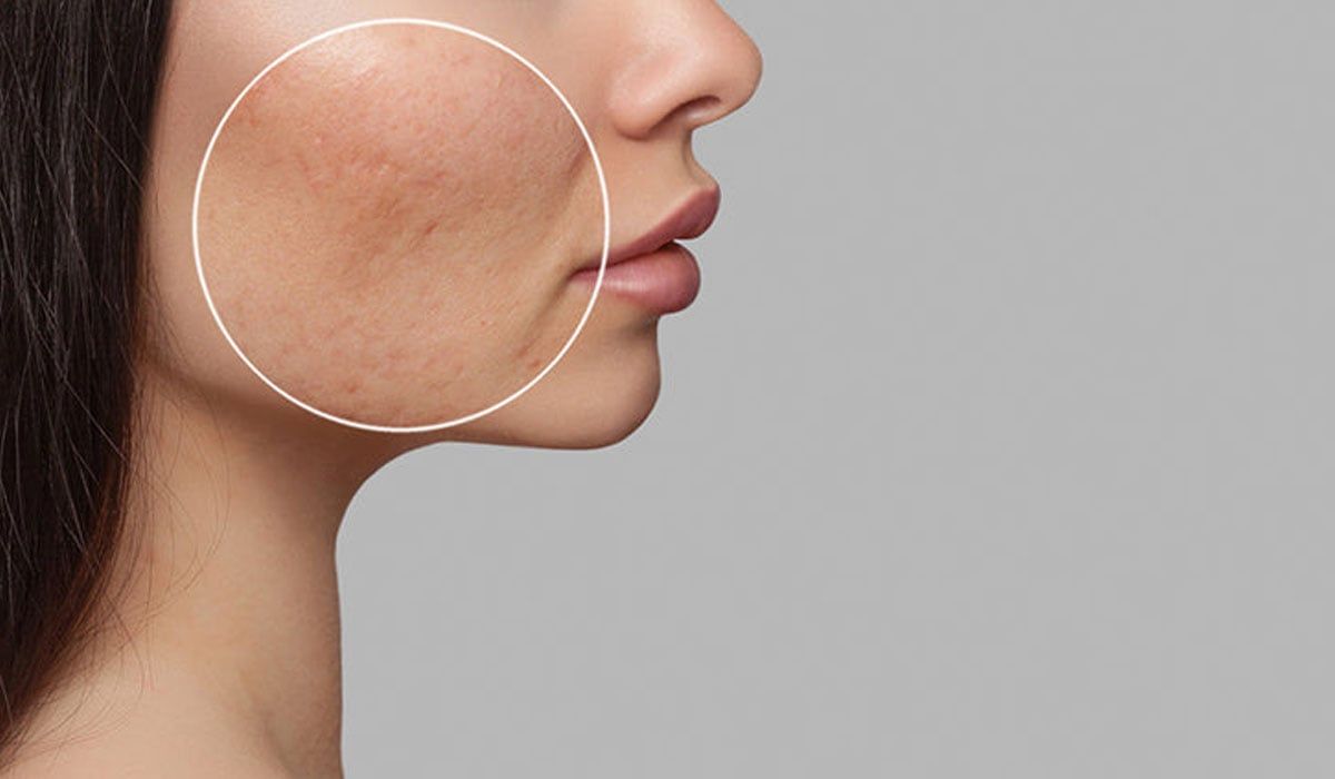 Nicole Ostrow on LinkedIn: Why You Should Consider RF Microneedling to ... Nicole Ostrow on LinkedIn: Why You Should Consider RF Microneedling to ...
