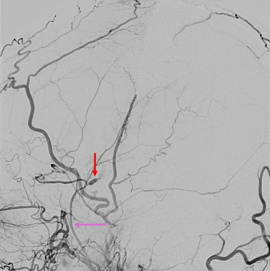 Society of NeuroInterventional Surgery on LinkedIn: Time to test your ... Society of NeuroInterventional Surgery on LinkedIn: Time to test your ...