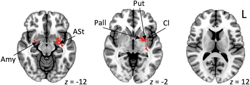 Phys.org on LinkedIn: Research identifies brain network link to stuttering Phys.org on LinkedIn: Research identifies brain network link to stuttering