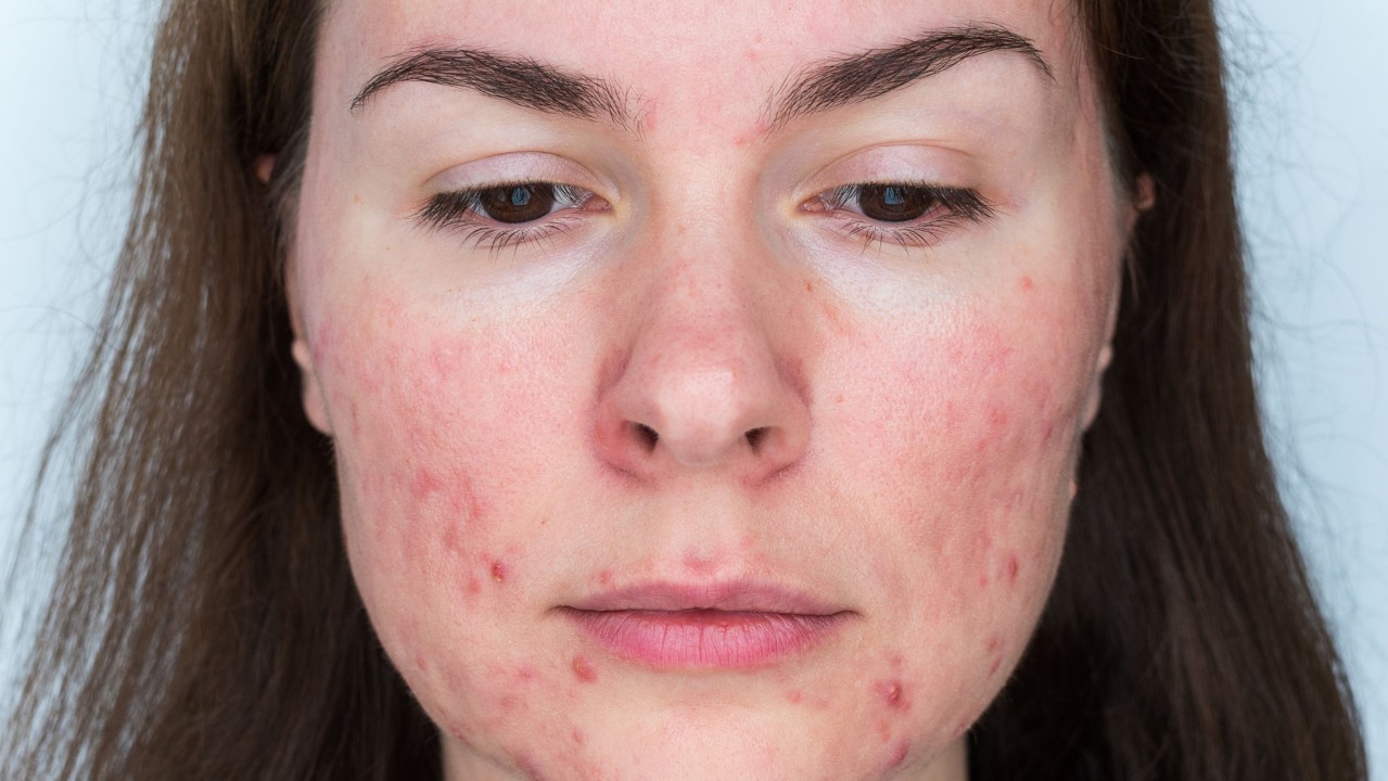 Demystifying Rosacea: Myths vs. Facts About This Skin Condition Demystifying Rosacea: Myths vs. Facts About This Skin Condition