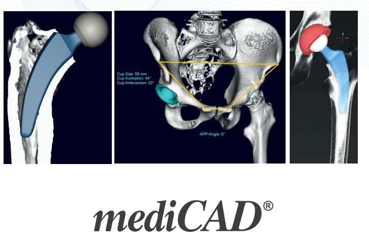 Bertrand Fravien on LinkedIn: #hip #orthopedics #surgicalplanning # ... Bertrand Fravien on LinkedIn: #hip #orthopedics #surgicalplanning # ...