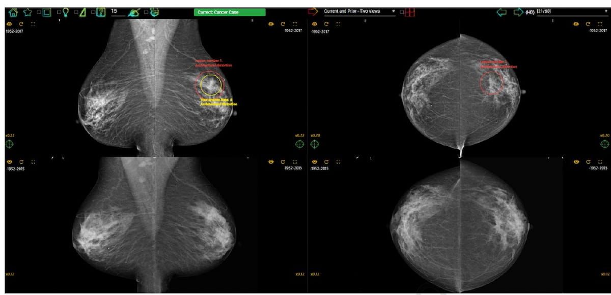 Diagnostic Imaging® on LinkedIn: #mammography #radiology #radres # ... Diagnostic Imaging® on LinkedIn: #mammography #radiology #radres # ...
