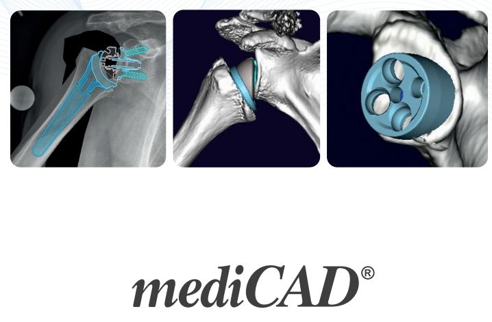 Bertrand Fravien on LinkedIn: #orthopedics #surgicalplanning # ... Bertrand Fravien on LinkedIn: #orthopedics #surgicalplanning # ...