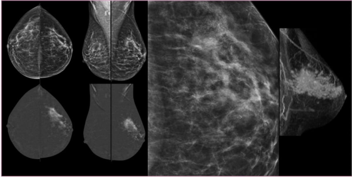 #mammography #radiology #radres #breastimaging | Diagnostic Imaging® #mammography #radiology #radres #breastimaging | Diagnostic Imaging®