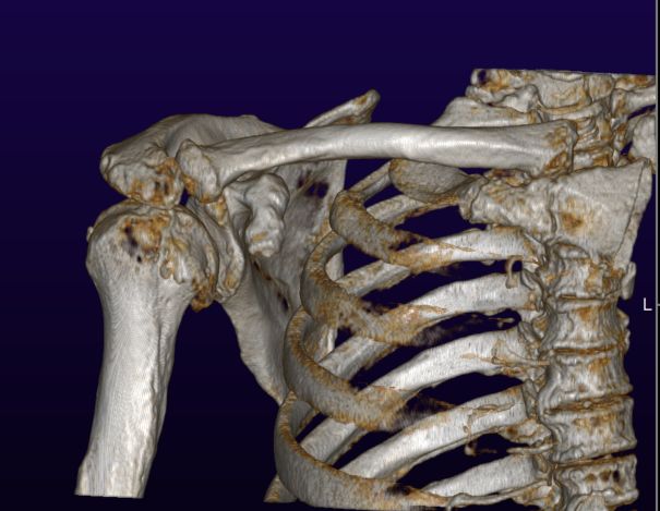 #clavicle #scapular #orthopedics #3dplanning #surgicalinnovation ... #clavicle #scapular #orthopedics #3dplanning #surgicalinnovation ...