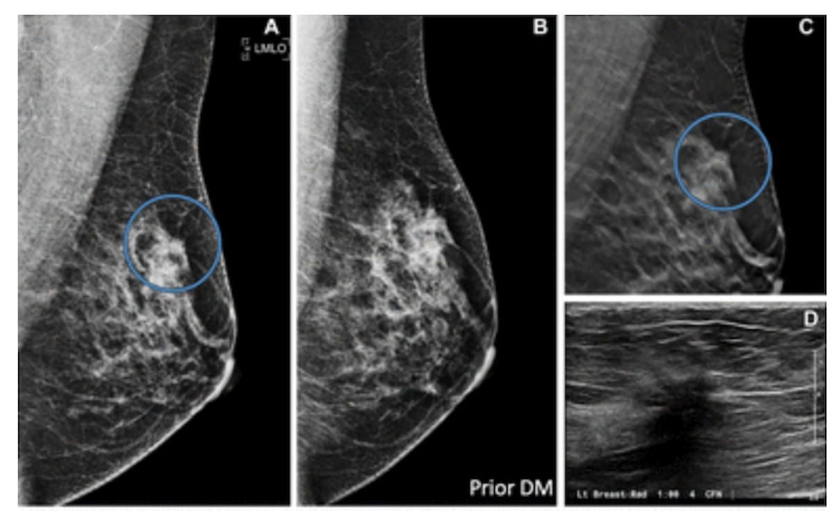 Diagnostic Imaging® on LinkedIn: #mammography #radiology #radres # ... Diagnostic Imaging® on LinkedIn: #mammography #radiology #radres # ...