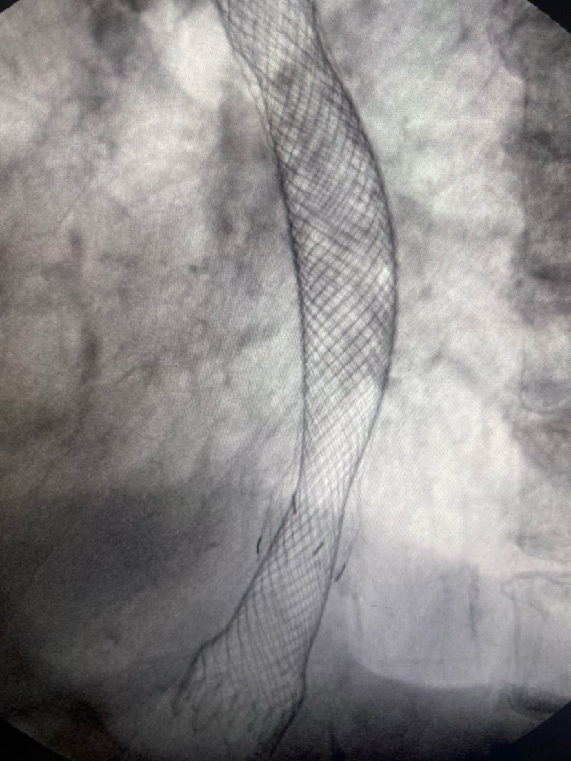 Rosario Ligresti MD FASGE on LinkedIn: When a “fully covered removable ... Rosario Ligresti MD FASGE on LinkedIn: When a “fully covered removable ...