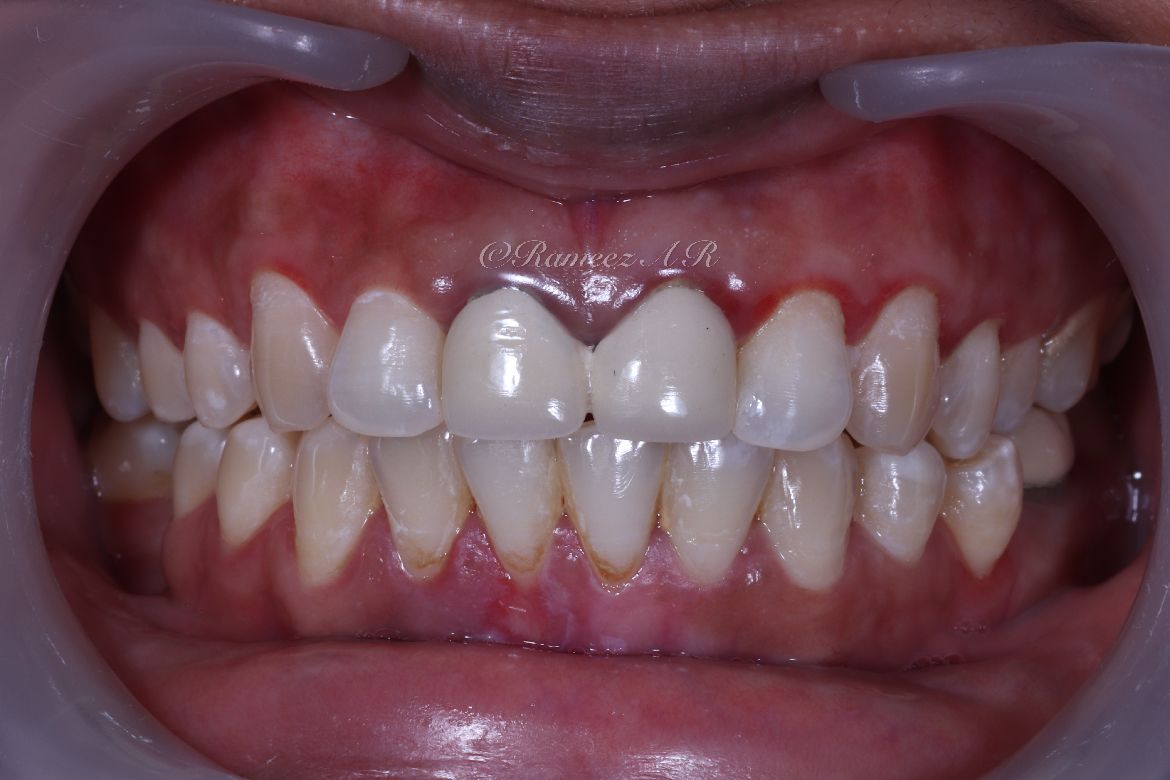 #smiledesign #smiledesigner #dentalveneers #veneers #emax #dentist ... #smiledesign #smiledesigner #dentalveneers #veneers #emax #dentist ...
