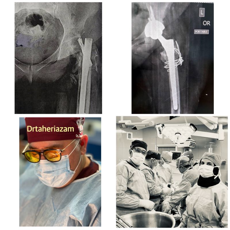 #arthroplasty #totalhipreplacement #hipsurgery #orthopedics # ... #arthroplasty #totalhipreplacement #hipsurgery #orthopedics # ...
