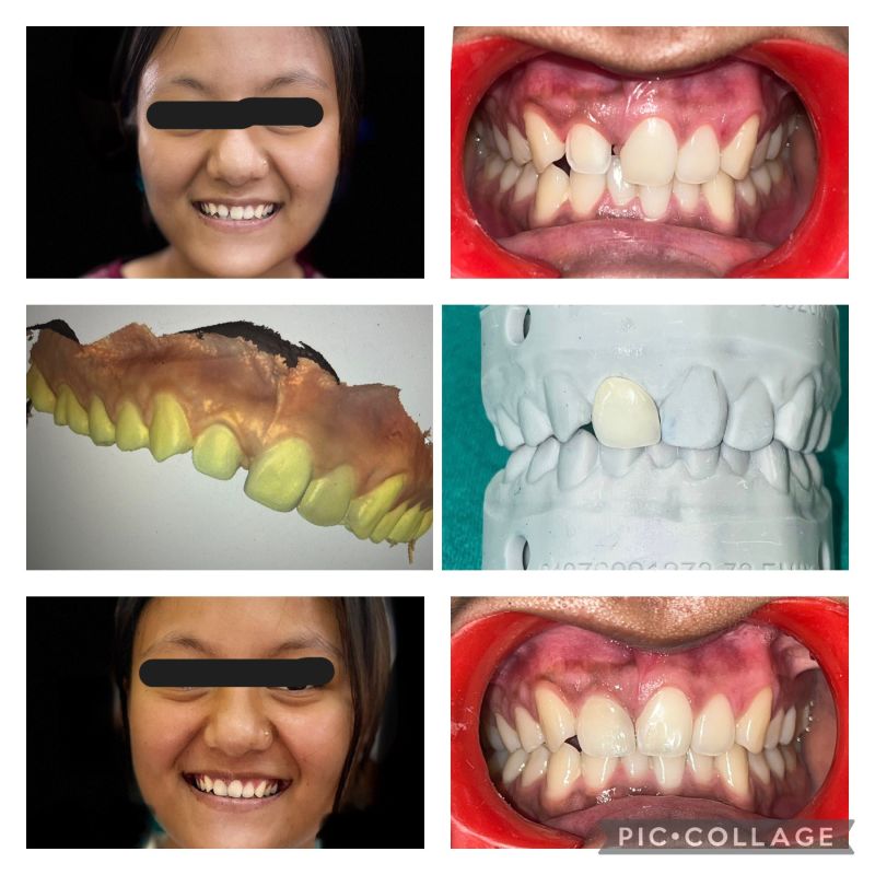 Dr. Koustav Maity on LinkedIn: ILLUSION: Missing central incisor ... Dr. Koustav Maity on LinkedIn: ILLUSION: Missing central incisor ...