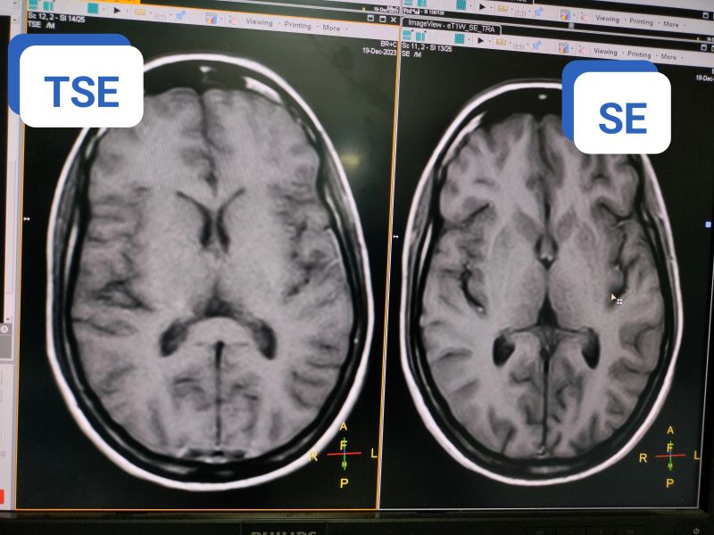 How TSE & SE affect brain image quality | Ritwik Biswas posted on the ... How TSE & SE affect brain image quality | Ritwik Biswas posted on the ...