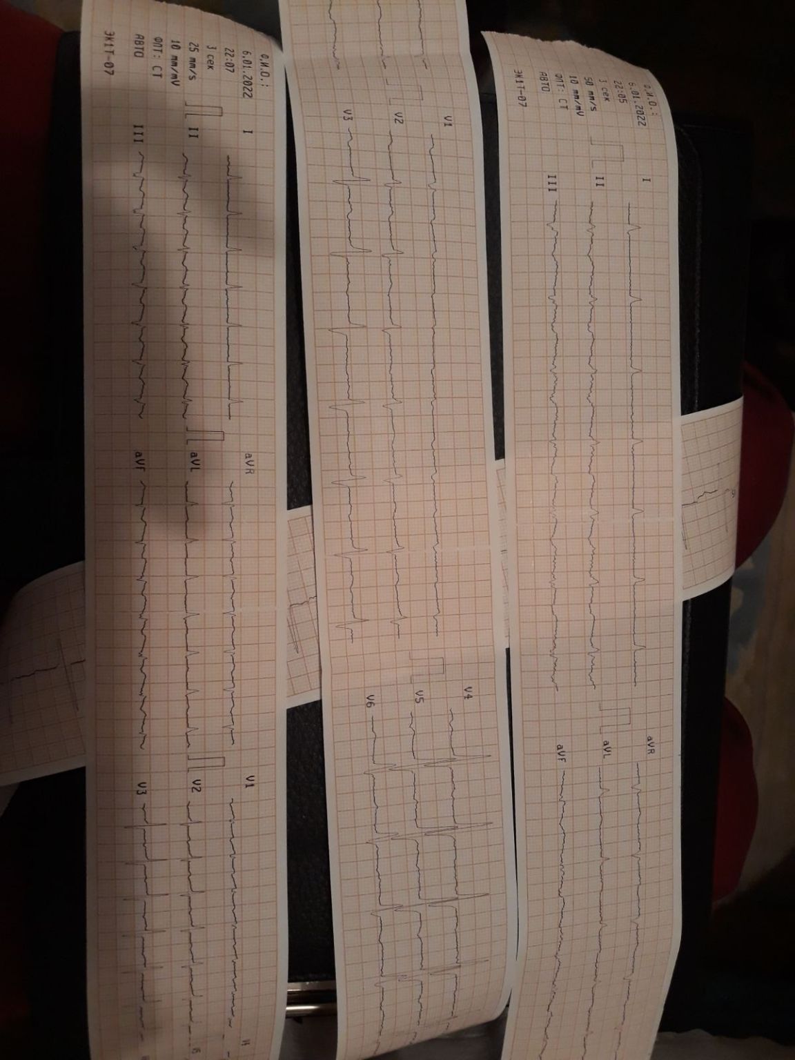 Dr. Prince Osei Sarpong on LinkedIn: Atrial flutter, correctly shaped Dr. Prince Osei Sarpong on LinkedIn: Atrial flutter, correctly shaped