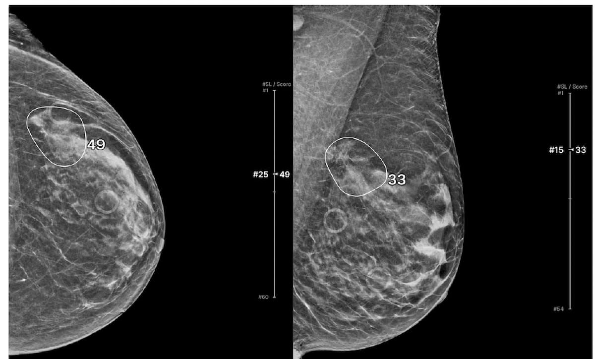 Diagnostic Imaging® on LinkedIn: #mammography #ai #breastcancer # ... Diagnostic Imaging® on LinkedIn: #mammography #ai #breastcancer # ...