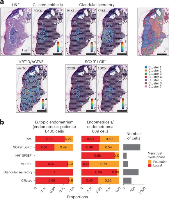 David Powell FREC on LinkedIn: Dissecting endometriosis by single-cell ... David Powell FREC on LinkedIn: Dissecting endometriosis by single-cell ...