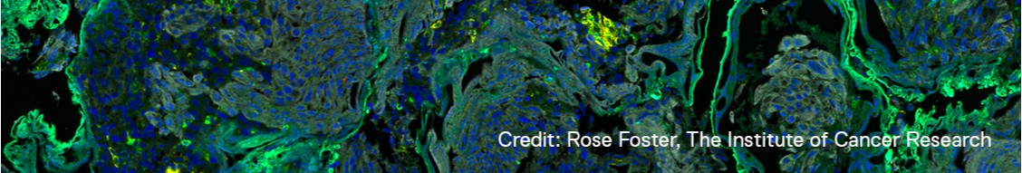 The Institute of Cancer Research on LinkedIn: Overcoming recurrence ... The Institute of Cancer Research on LinkedIn: Overcoming recurrence ...