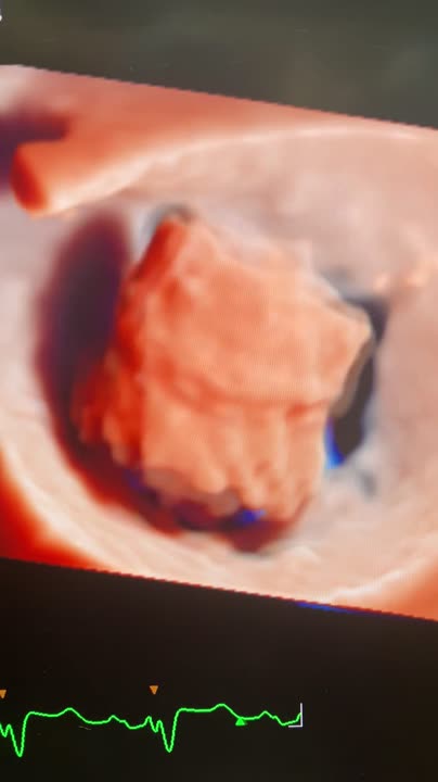 Clear distinction between ring and Mitral prosthesis (Valve in Ring ... Clear distinction between ring and Mitral prosthesis (Valve in Ring ...