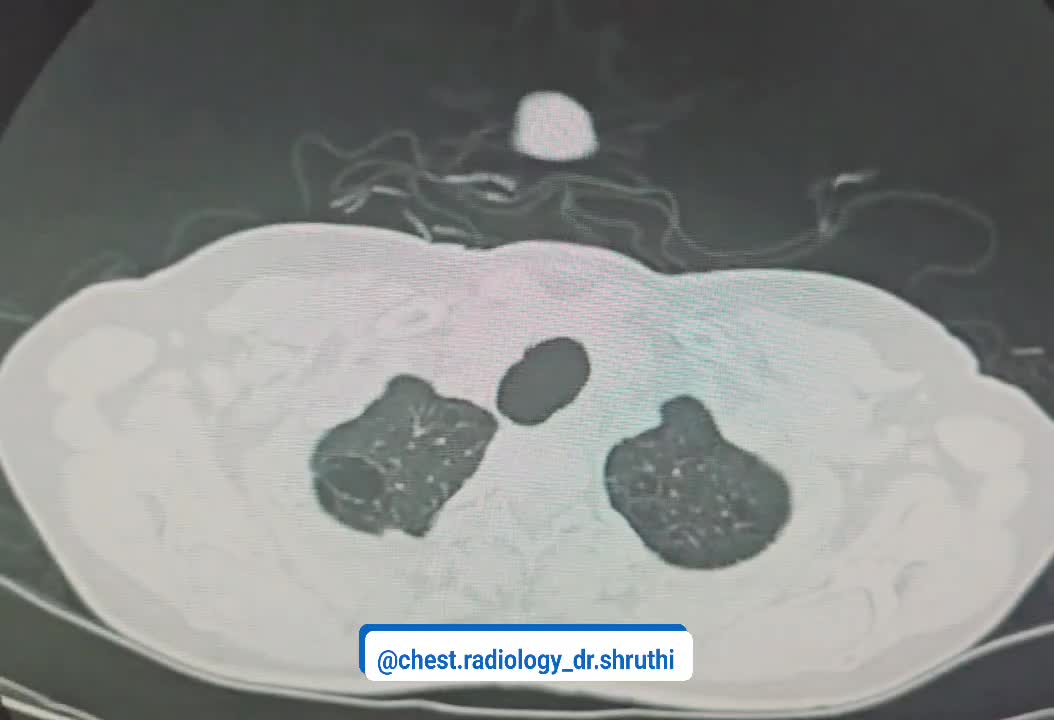 #caseoftheday #chestradiology #thoracicradiology | Shruthi P #caseoftheday #chestradiology #thoracicradiology | Shruthi P