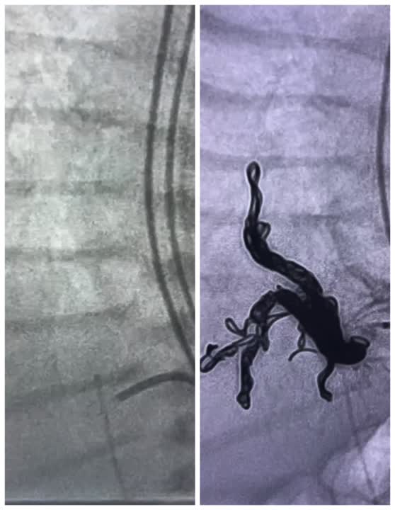 Ruben Garcia (CVT) on LinkedIn: Ruby Coils ️ 2.8Kg BG O2 Sat improved ... Ruben Garcia (CVT) on LinkedIn: Ruby Coils ️ 2.8Kg BG O2 Sat improved ...