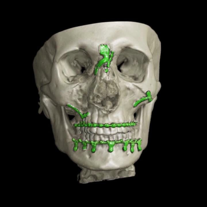 3D imaging of facial fractures at post-op | Stanford 3D & Quantitative ... 3D imaging of facial fractures at post-op | Stanford 3D & Quantitative ...