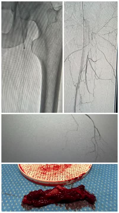 Bolt 7 ⚡️ Modulated aspiration designed to rapidly remove thrombus and ... Bolt 7 ⚡️ Modulated aspiration designed to rapidly remove thrombus and ...