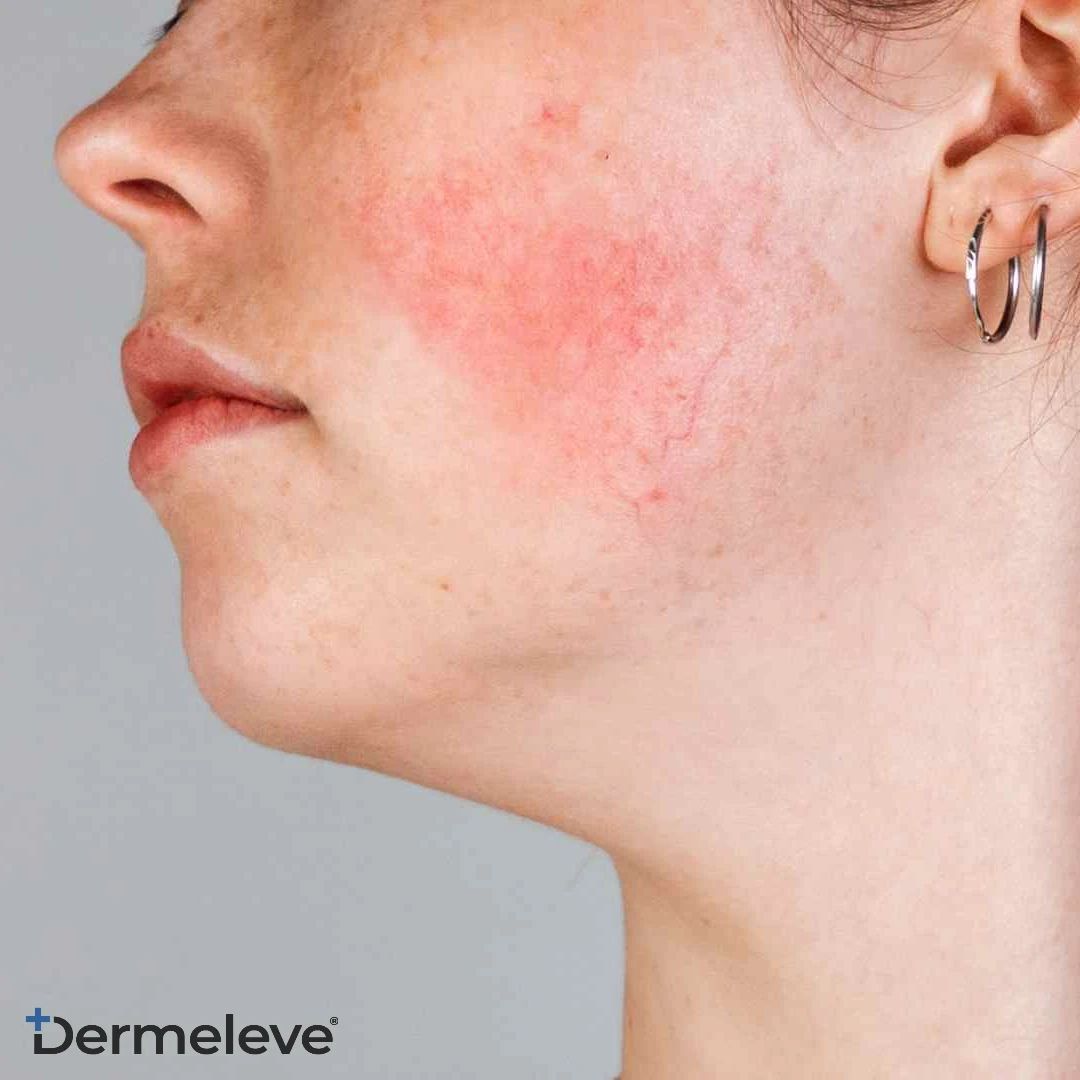 Daniel Pike on LinkedIn: Red Alert: Lupus Rash vs. Rosacea - The Skin ... Daniel Pike on LinkedIn: Red Alert: Lupus Rash vs. Rosacea - The Skin ...