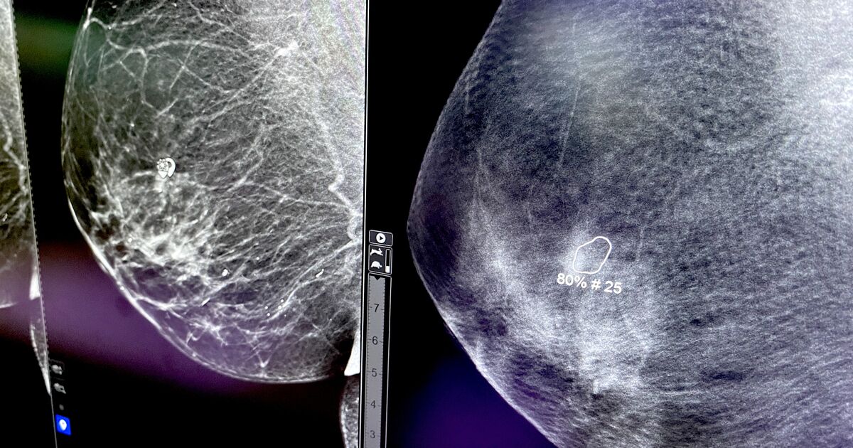 AI in Healthcare on LinkedIn: GE HealthCare debuts AI suite for early ... AI in Healthcare on LinkedIn: GE HealthCare debuts AI suite for early ...