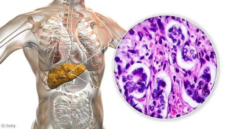 Alex Bollwage on LinkedIn: Hepatocellular Carcinoma Risk Panel with ... Alex Bollwage on LinkedIn: Hepatocellular Carcinoma Risk Panel with ...