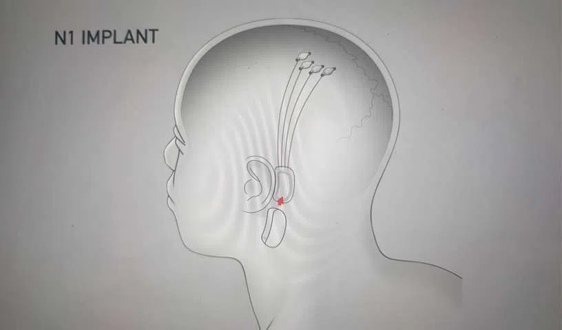 Neuralink begins recruiting for first human brain-computer trial Neuralink begins recruiting for first human brain-computer trial