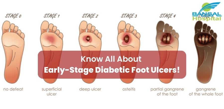 Know All About Early-Stage Diabetic Foot Ulcers! Know All About Early-Stage Diabetic Foot Ulcers!
