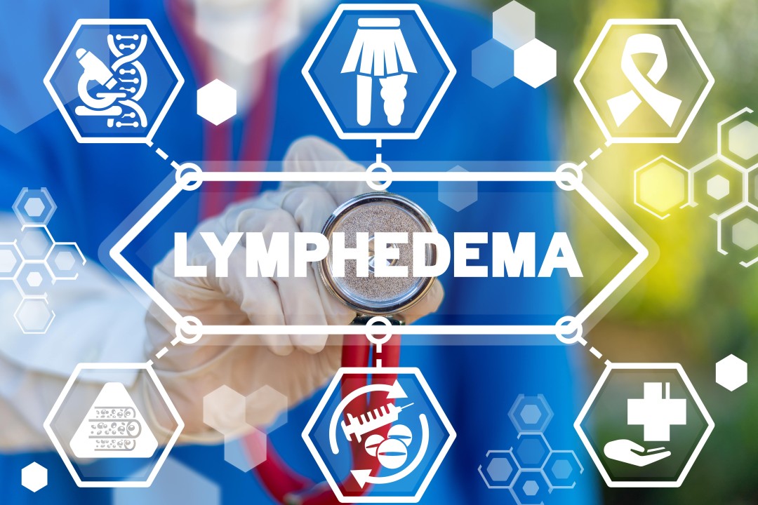 Taming the Tides: Strategies for Managing Lymphedema | theresa sonneville Taming the Tides: Strategies for Managing Lymphedema | theresa sonneville
