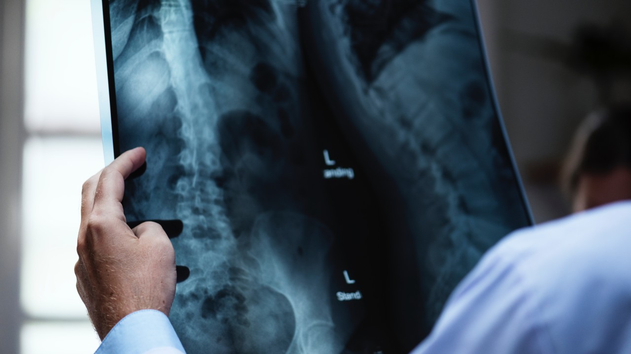 Advancing Radiology with AI-Powered Vision Language Models Advancing Radiology with AI-Powered Vision Language Models