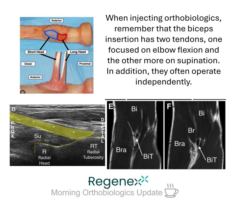 Chris Centeno, M.D. on LinkedIn: When injecting the biceps tendon ... Chris Centeno, M.D. on LinkedIn: When injecting the biceps tendon ...