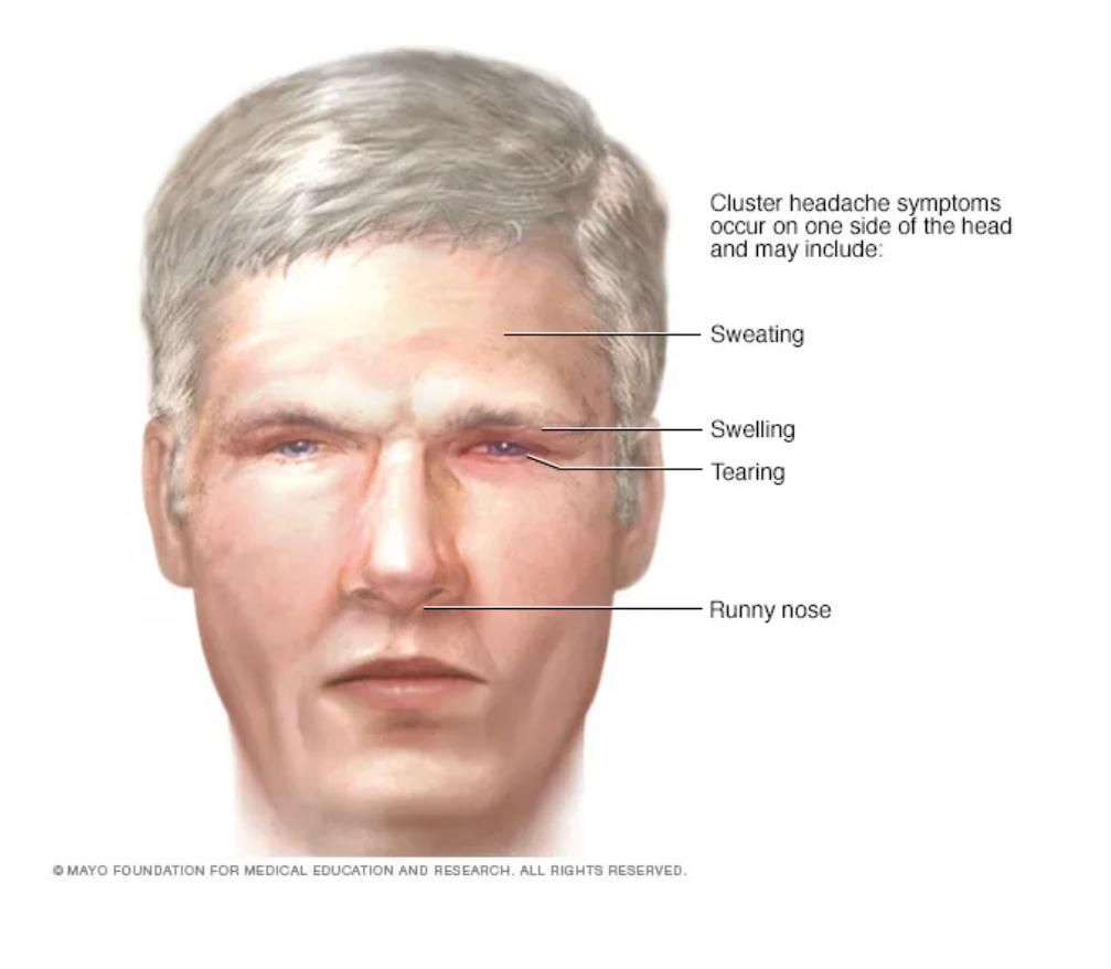 Dr.Zehra Jaffar on LinkedIn: Some Important points on CLUSTER HEADACHE ... Dr.Zehra Jaffar on LinkedIn: Some Important points on CLUSTER HEADACHE ...