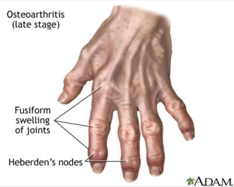 Arthritis: How to manage symptoms and treat it | Mohamed Rishal posted ... Arthritis: How to manage symptoms and treat it | Mohamed Rishal posted ...