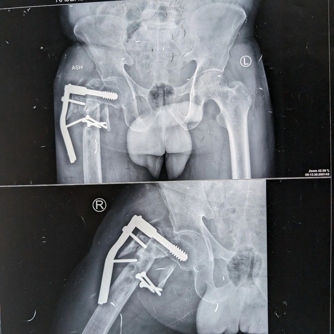 Pon Aravindhan A S on LinkedIn: 55/M ,smoker presenting with failed DCS ... Pon Aravindhan A S on LinkedIn: 55/M ,smoker presenting with failed DCS ...