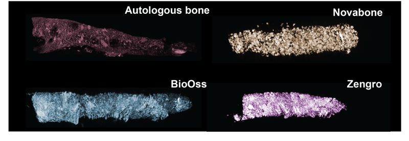 “Autologous bone replacement remains the preferred treatment for ... “Autologous bone replacement remains the preferred treatment for ...