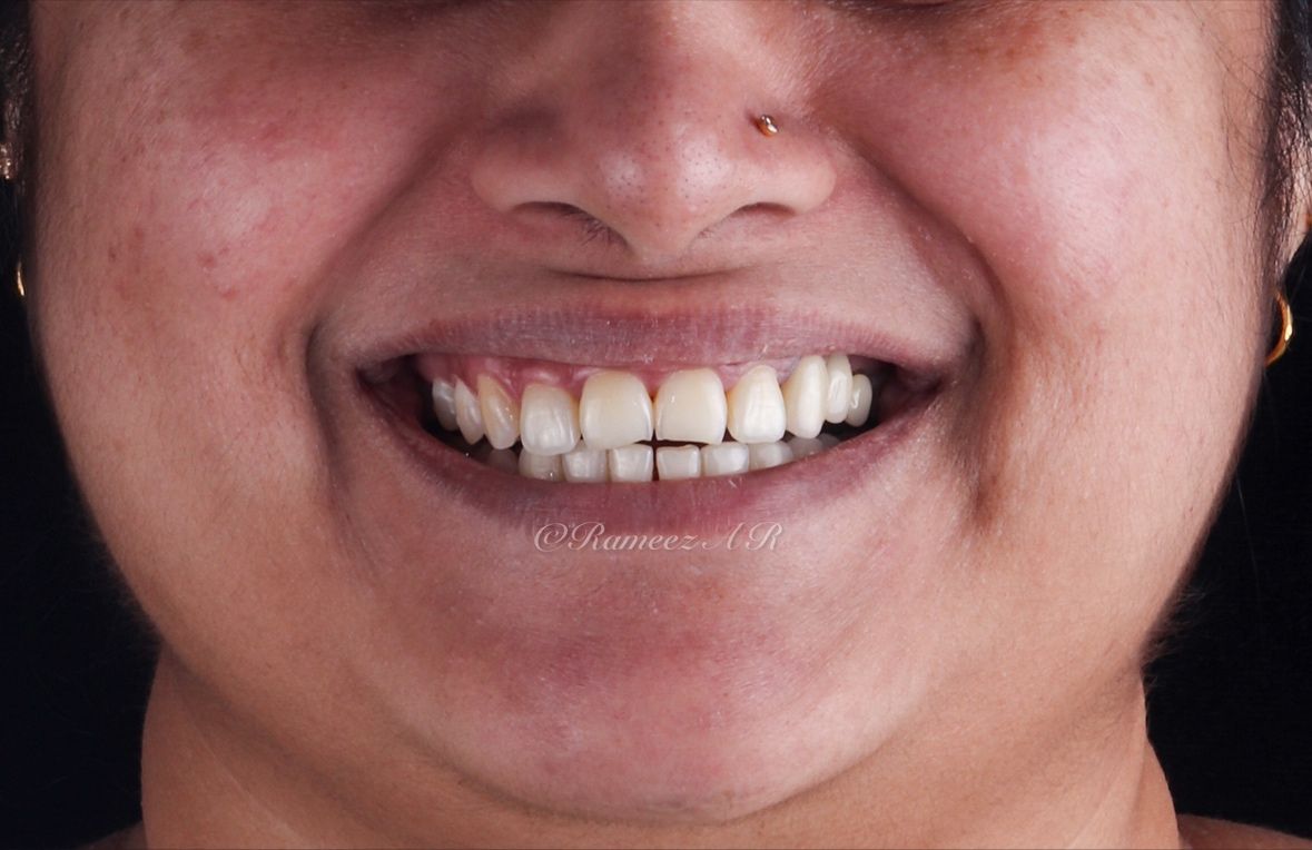 Abdul Rahiman Rameez on LinkedIn: #caries #anterior #incisor # ... Abdul Rahiman Rameez on LinkedIn: #caries #anterior #incisor # ...