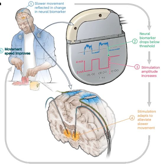 Bioelectronics Drop on LinkedIn: #stimulation Bioelectronics Drop on LinkedIn: #stimulation