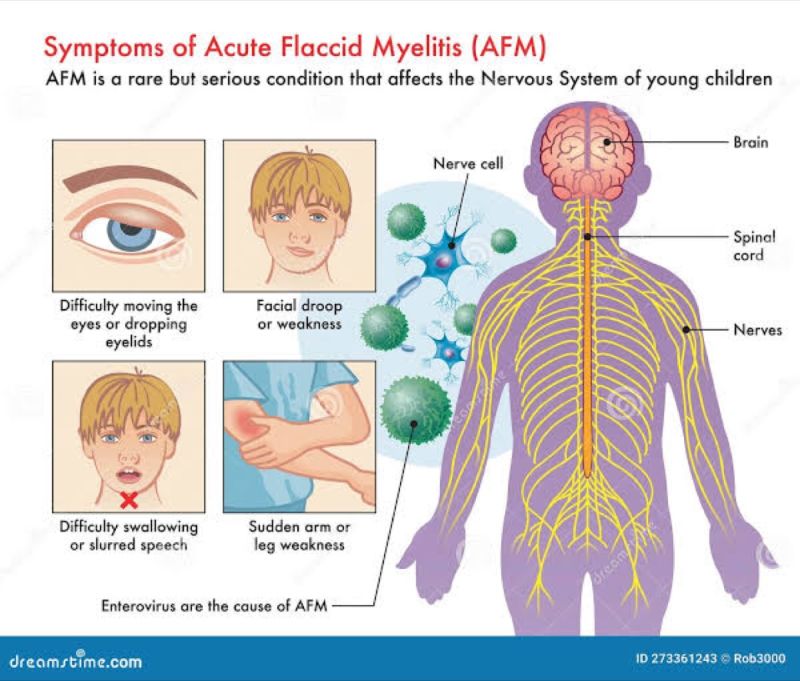 AFM: a rare but serious condition | Mohamed Rishal posted on the topic ... AFM: a rare but serious condition | Mohamed Rishal posted on the topic ...