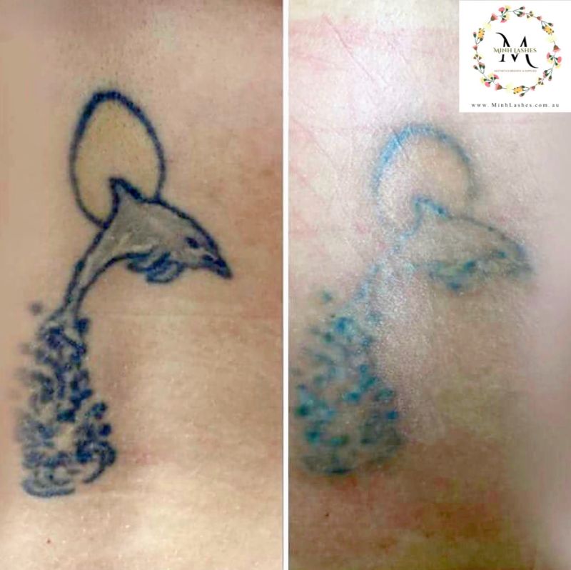 Minh Lashes Beauty Clinic on LinkedIn: #tattooremoval #freshstart # ... Minh Lashes Beauty Clinic on LinkedIn: #tattooremoval #freshstart # ...