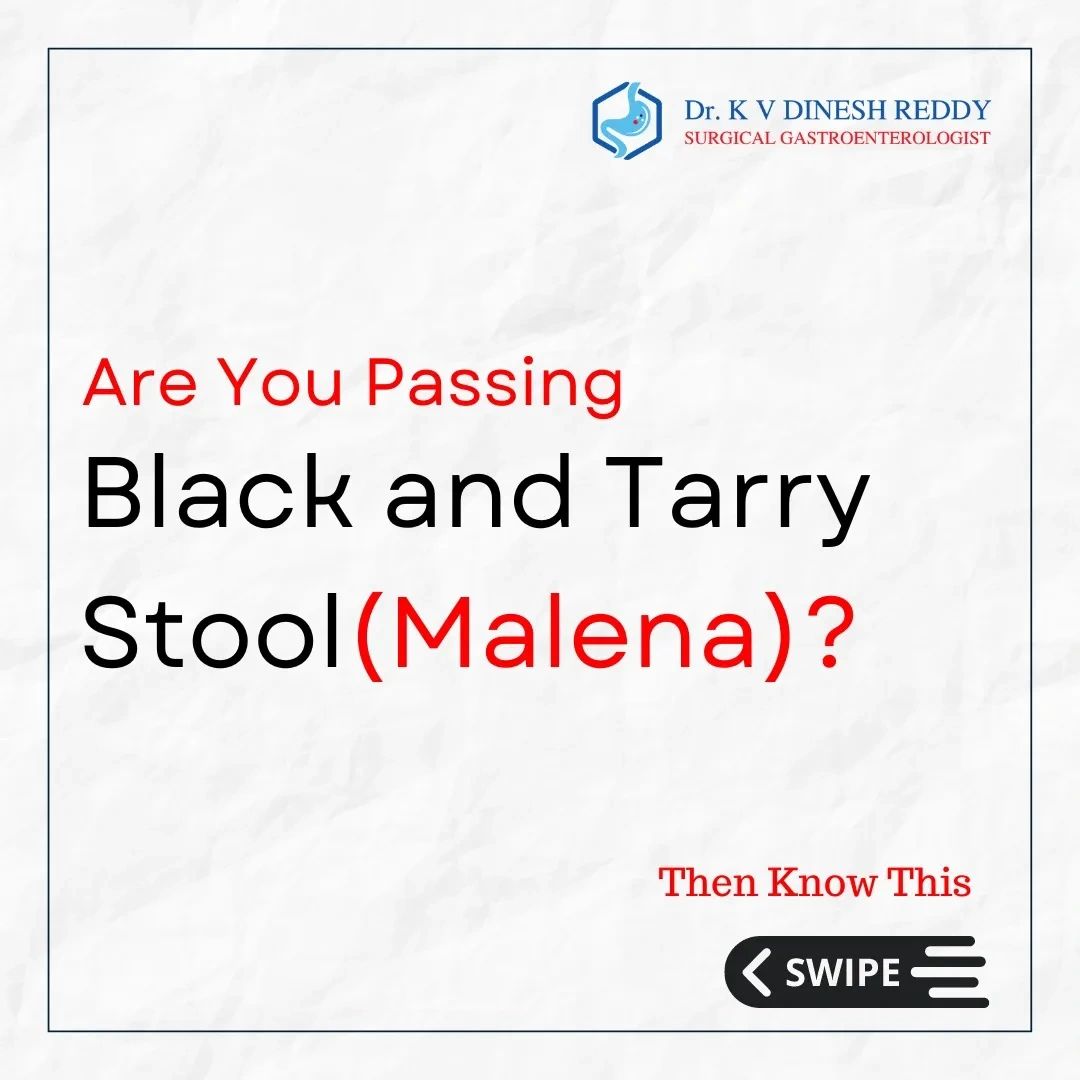 K V DINESH REDDY on LinkedIn: Black and Tarry Stool(Malena) # ... K V DINESH REDDY on LinkedIn: Black and Tarry Stool(Malena) # ...