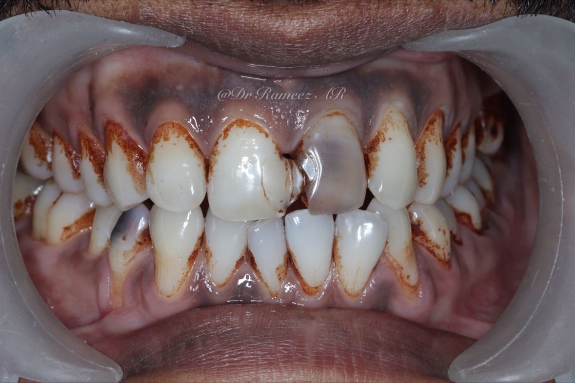 #prophylaxis #dentistry #dentist #compositerestoration #composites ... #prophylaxis #dentistry #dentist #compositerestoration #composites ...