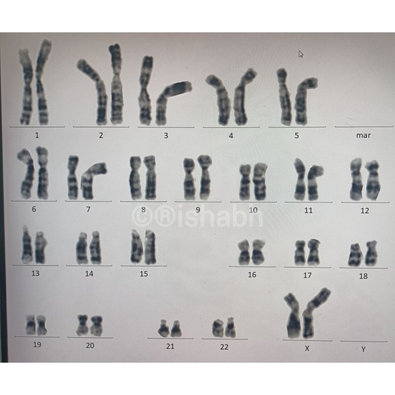 Rishabh Pandey on LinkedIn: A uncommon chromosomal finding has been ... Rishabh Pandey on LinkedIn: A uncommon chromosomal finding has been ...