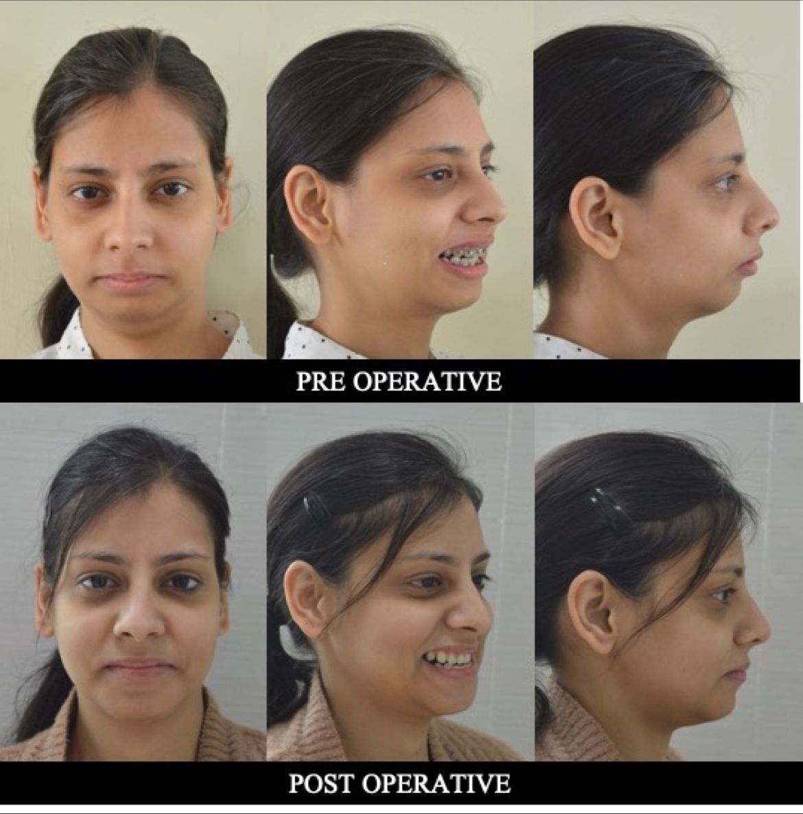 Dr. Shayan Ghosh on LinkedIn: Retrognathia Correction Dr. Shayan Ghosh on LinkedIn: Retrognathia Correction