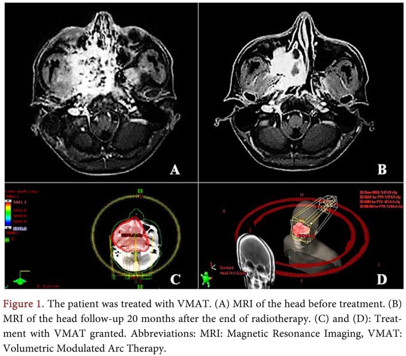 Scientific Research Publishing, Inc. USA on LinkedIn: #nasopharyngeal ... Scientific Research Publishing, Inc. USA on LinkedIn: #nasopharyngeal ...