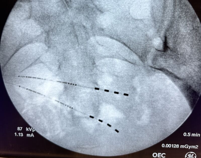 Robert Moghim, M.D. on LinkedIn: #crps #pns #chronicpain #surgery #crps ... Robert Moghim, M.D. on LinkedIn: #crps #pns #chronicpain #surgery #crps ...