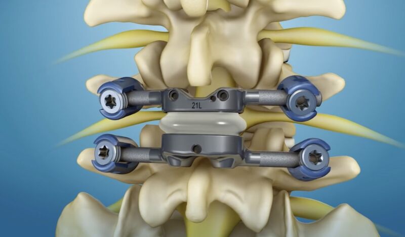 Premia Spine on LinkedIn: Premia Spine Premia Spine on LinkedIn: Premia Spine