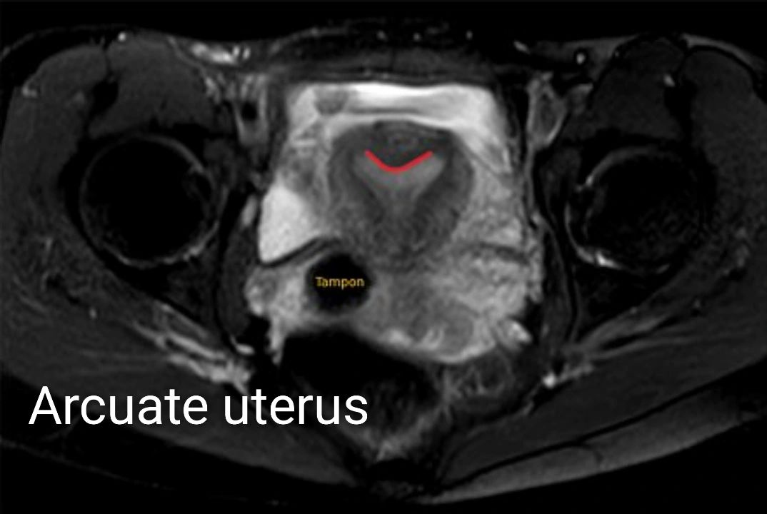 Mirey Jarjous on LinkedIn: #uterus #arcuate #septate #bicornuate # ... Mirey Jarjous on LinkedIn: #uterus #arcuate #septate #bicornuate # ...