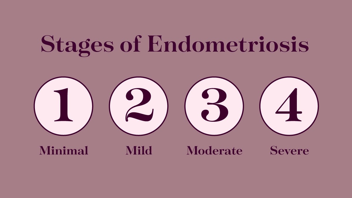 Kofinas Fertility Group on LinkedIn: What is endometriosis? How do you ... Kofinas Fertility Group on LinkedIn: What is endometriosis? How do you ...